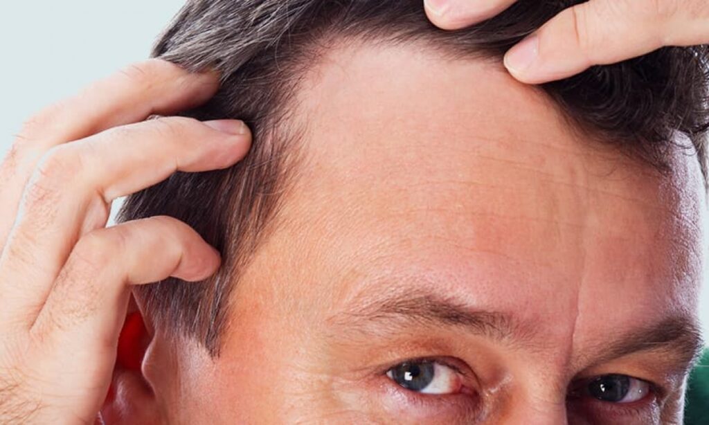 O que está por trás da Calvície? - Instituto Neurosistêmico